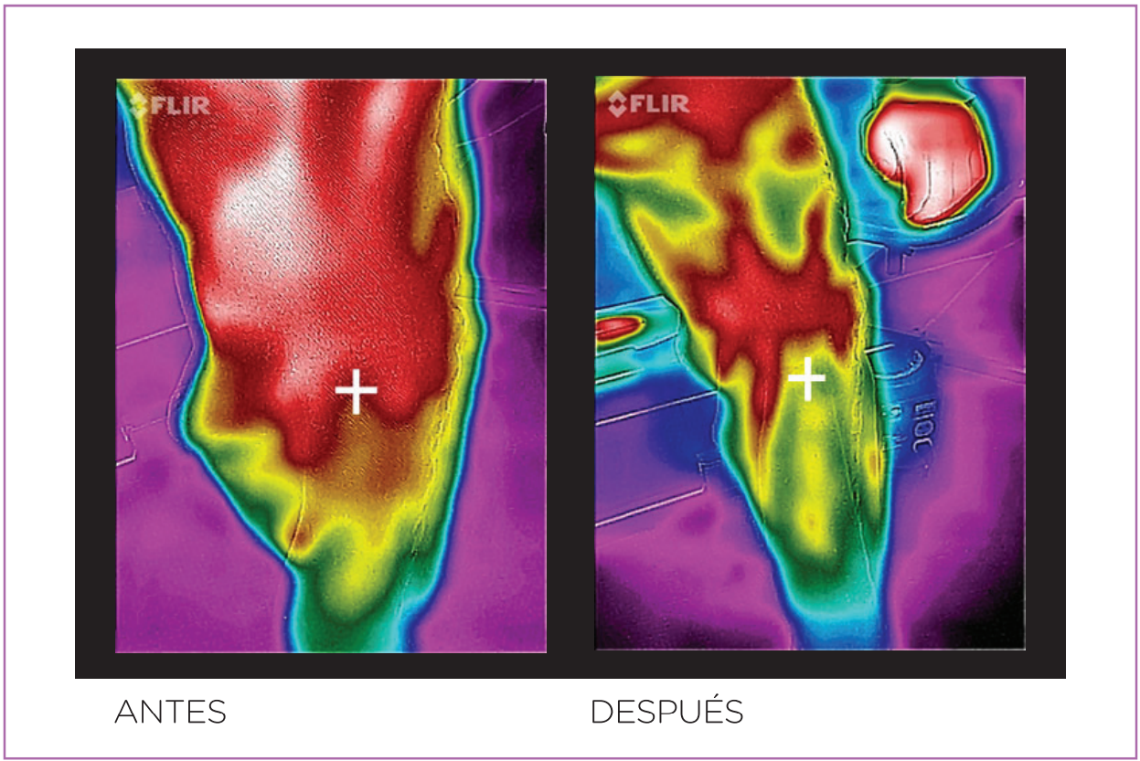 Tratamientos con plasma atmosférico frio en México - Theraphi en México
